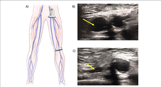 PoCUS Pitfalls EMRA