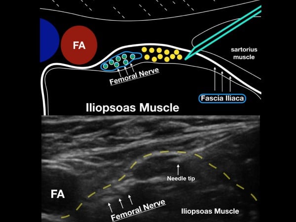 Ultrasound-Guided Nerve Blocks EMRA