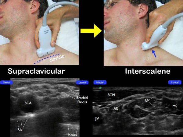 Ultrasound-Guided Nerve Blocks EMRA
