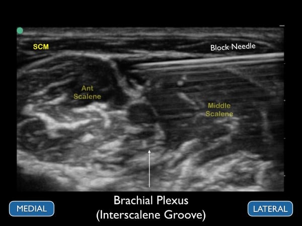 Ultrasound-Guided Nerve Blocks EMRA