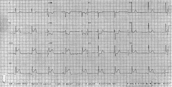 ECG Challenge EMRA