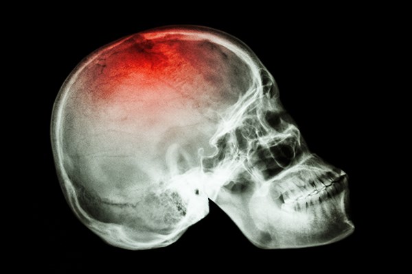 Revisiting Cerebral Perfusion Pressure EMRA