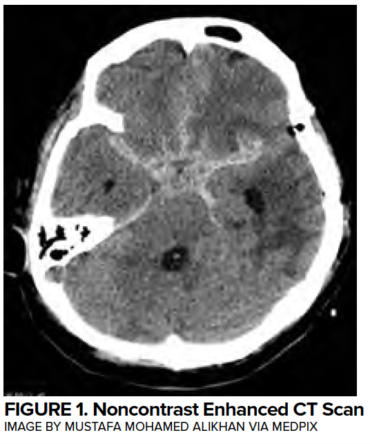 Cardiac Complications from Subarachnoid Hemorrhage EMRA
