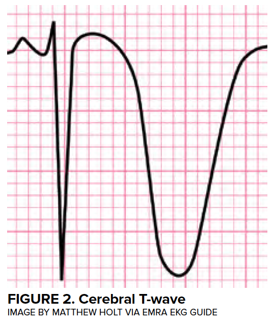 Cardiac Complications from Subarachnoid Hemorrhage EMRA