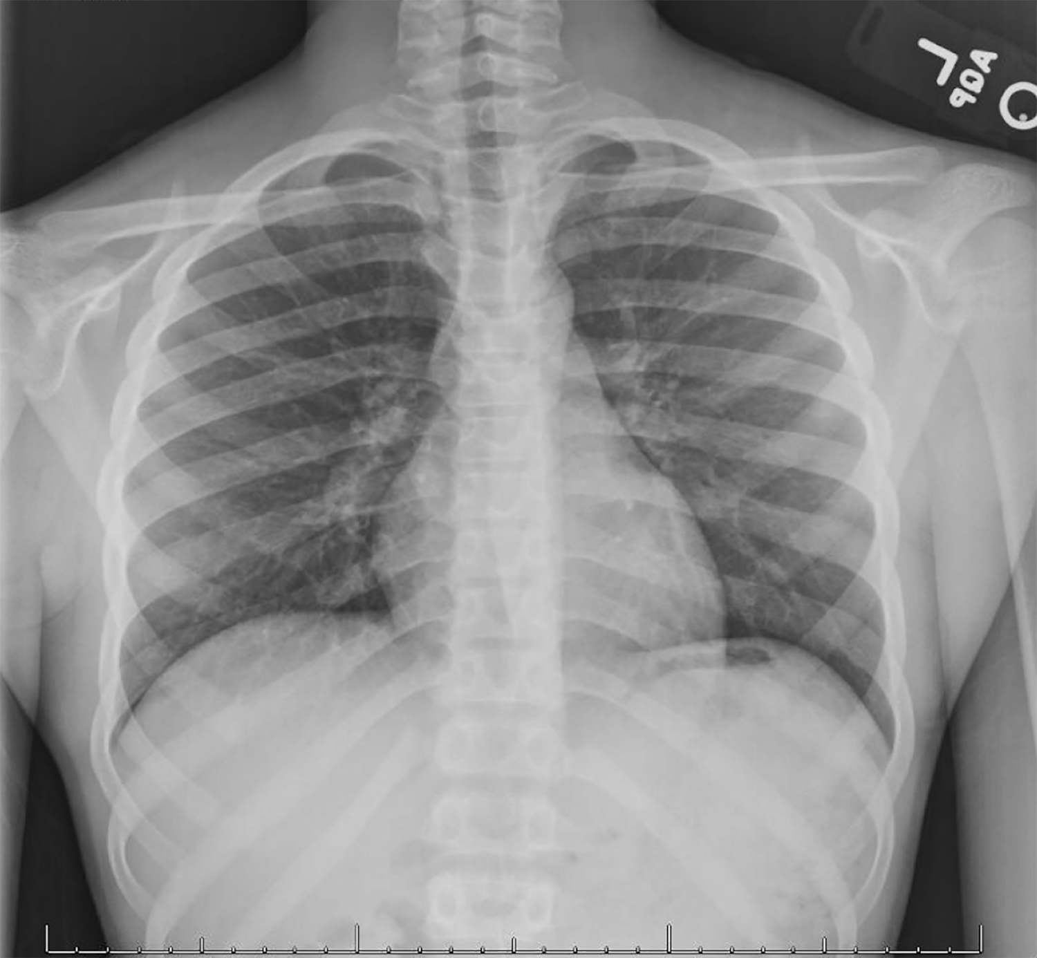 Recanting Impressions: Posterior Sternoclavicular Joint Dislocation EMRA