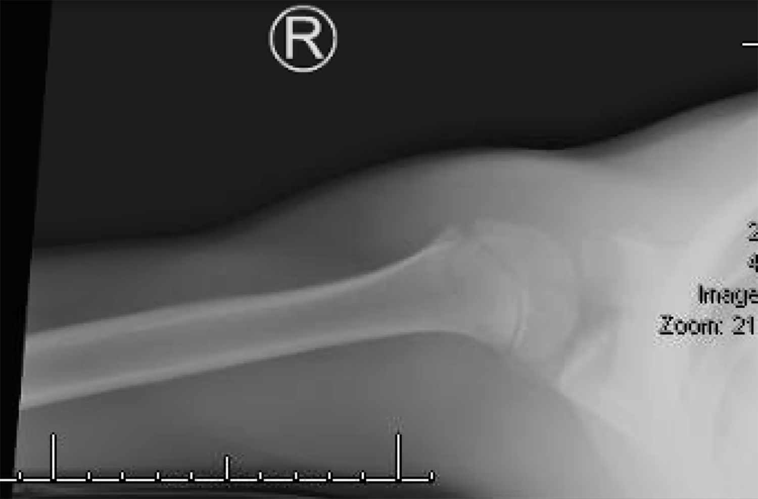 Recanting Impressions: Posterior Sternoclavicular Joint Dislocation EMRA