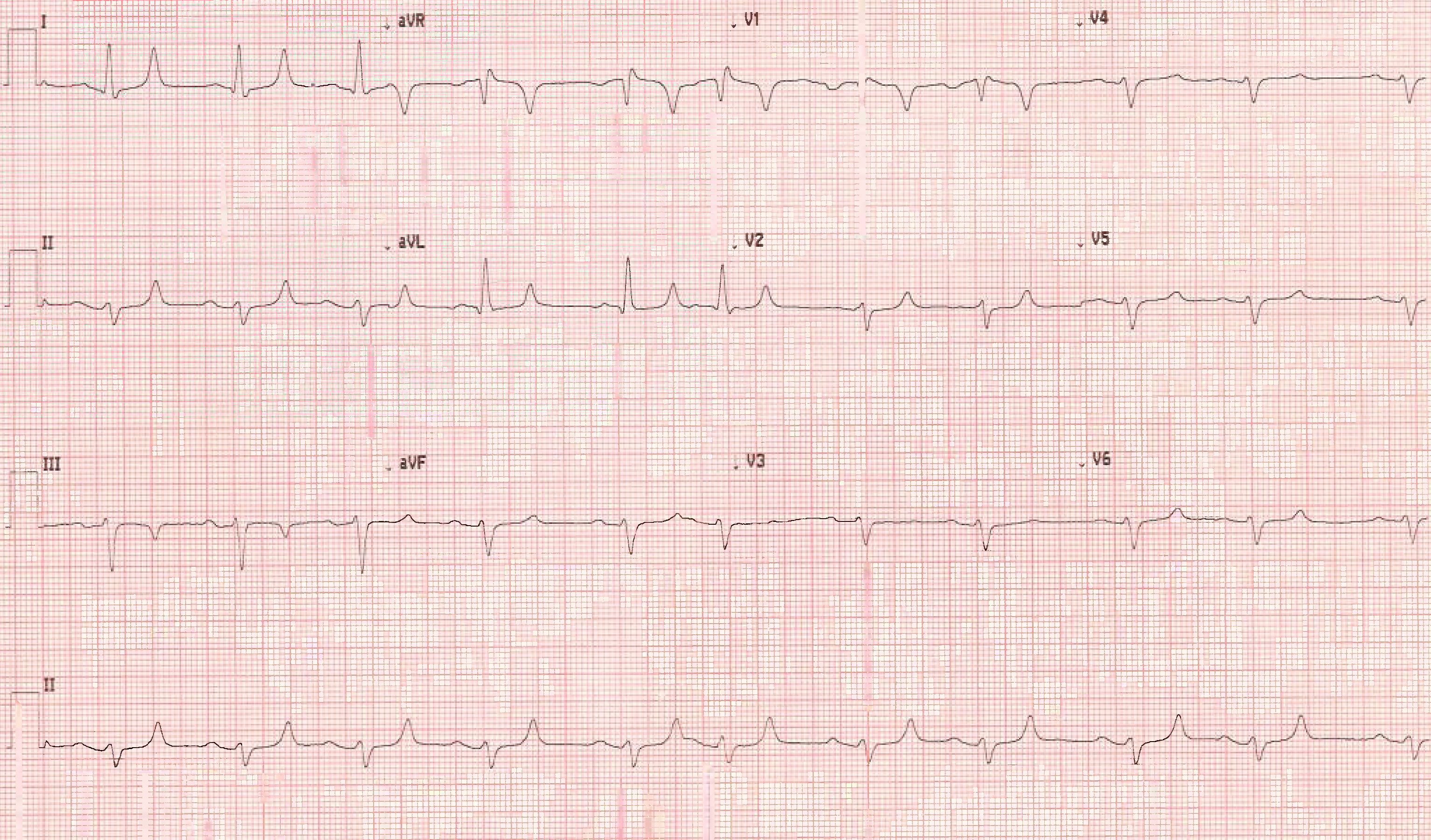Hyperkalemia Ekg