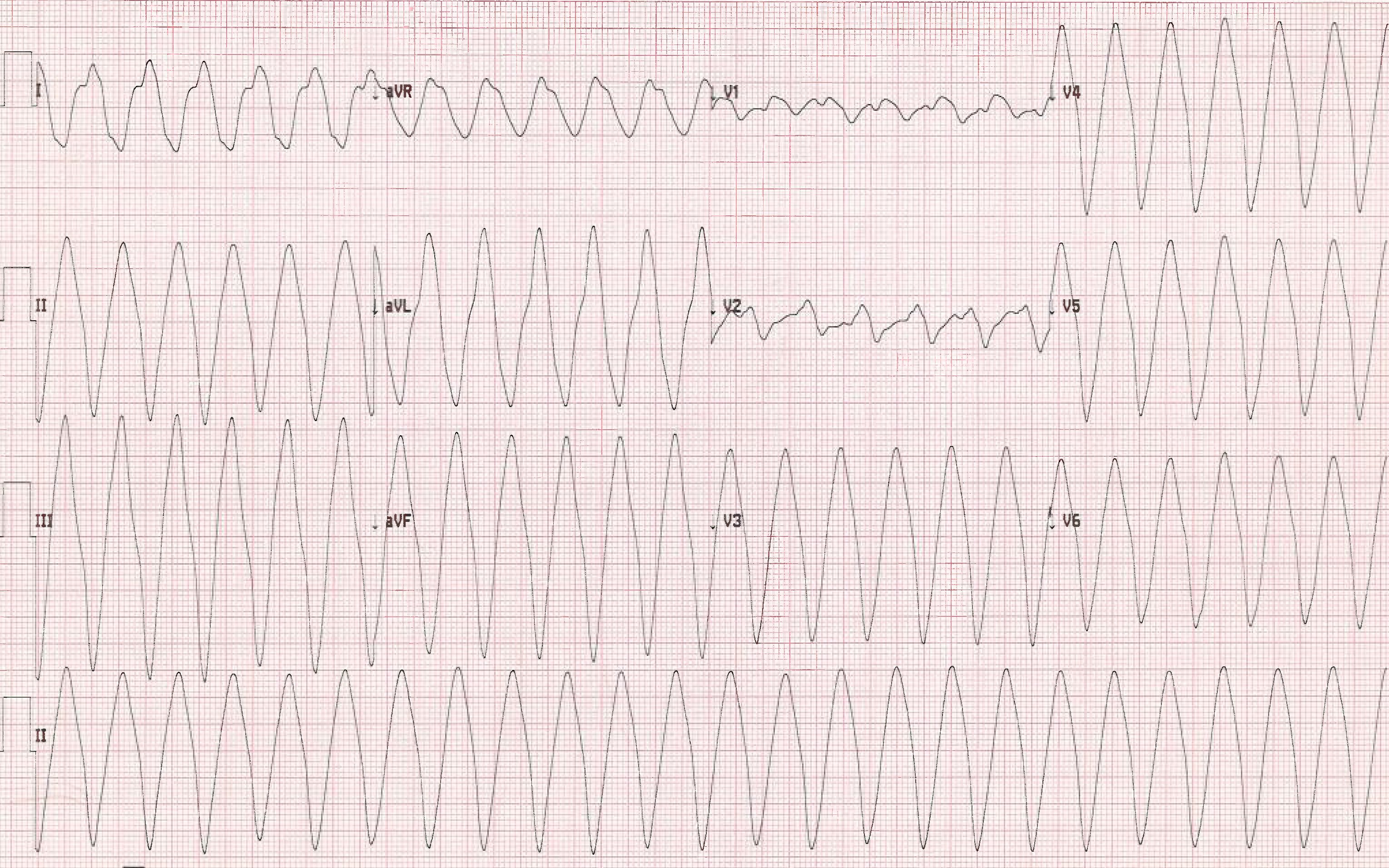 Hyperkalemia Ecg Sine Wave