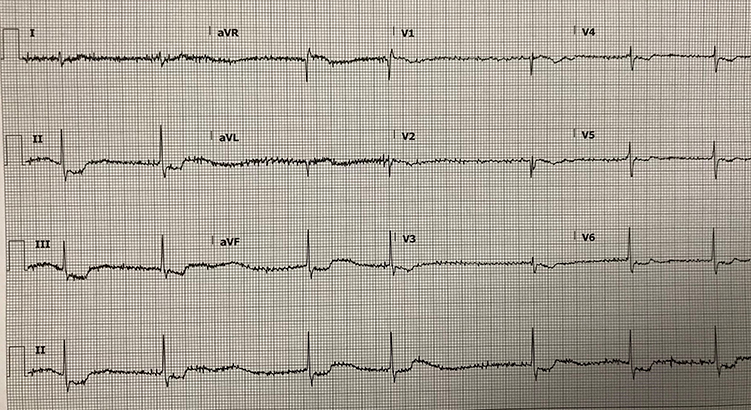 ECG Challenge: August 2018 EMRA