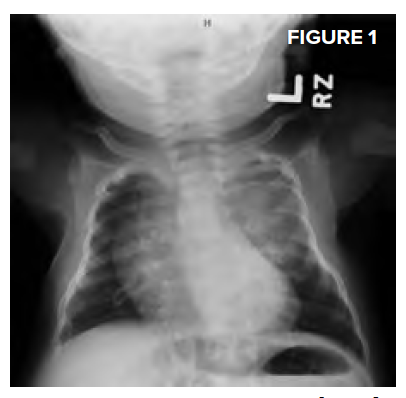 Flaccid Paralysis in a 7-week-old Infant EMRA