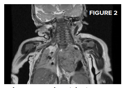 Flaccid Paralysis in a 7-week-old Infant EMRA