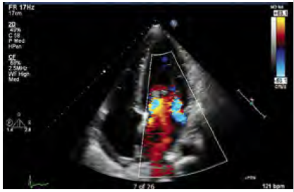 Rheumatic Heart Disease in the United States: A Thing of the Past or ...