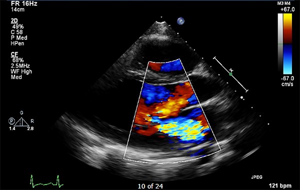 Rheumatic Heart Disease in the United States: A Thing of the Past or ...