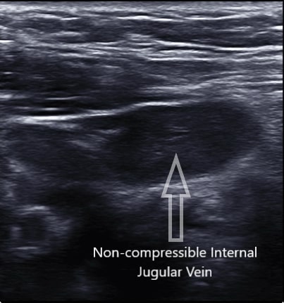 Rare Occurrence of Lemierre's Syndrome: A Case Report EMRA