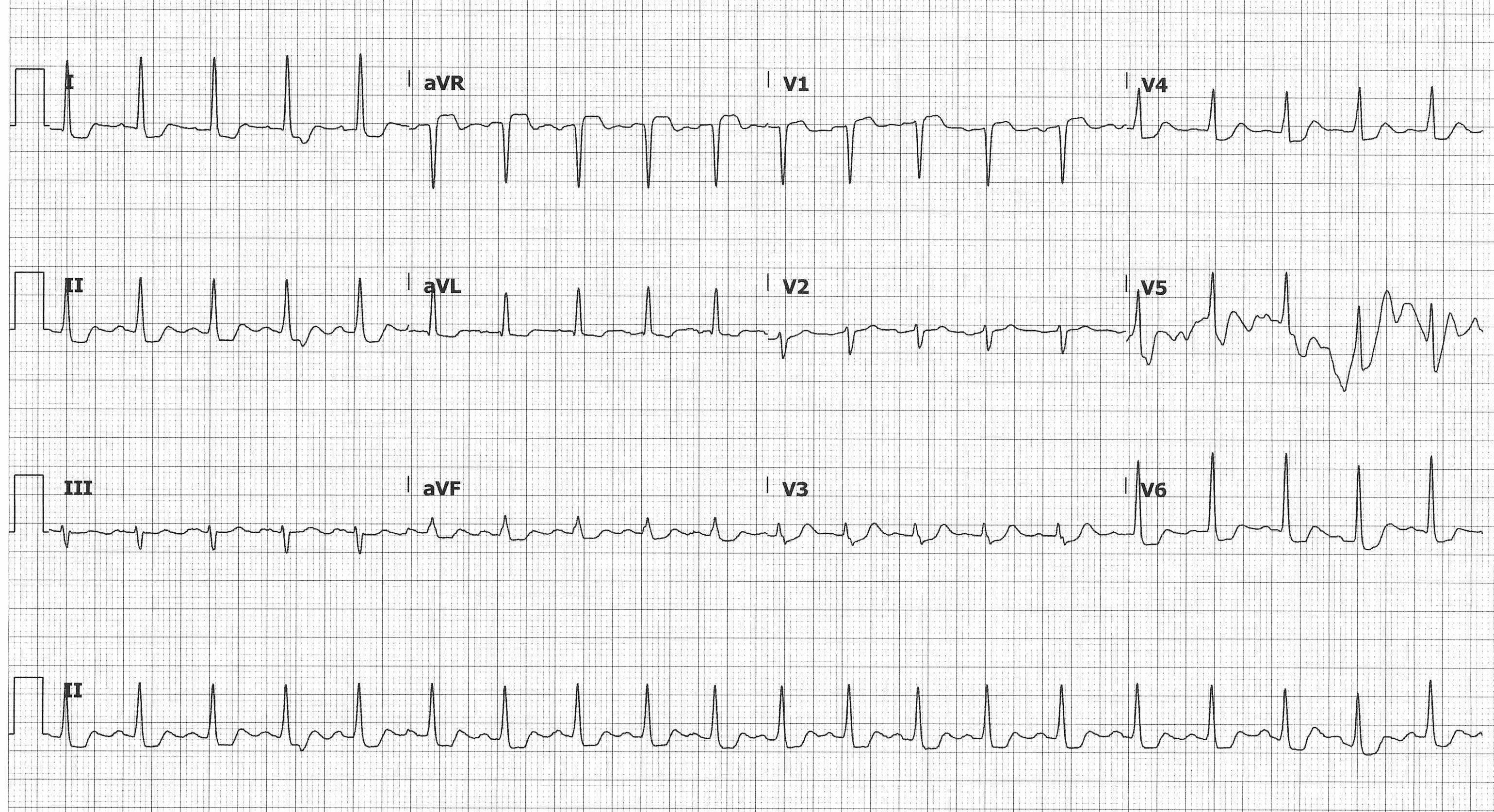 ECG Challenge: June 2019 EMRA