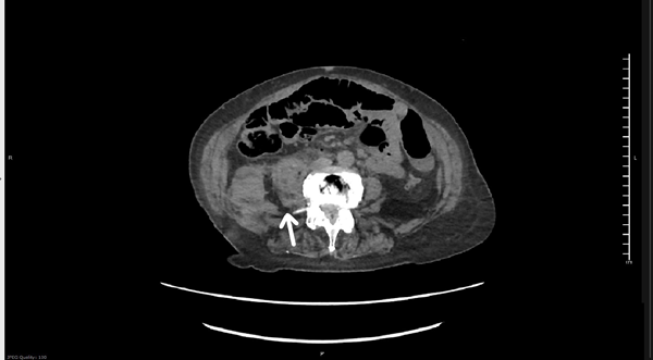 Iliopsoas Rupture and Hematoma: A Rare Cause of Inability to Ambulate EMRA
