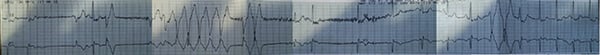 Non-Sustained Ventricular Tachycardia Following Modified Valsalva ...