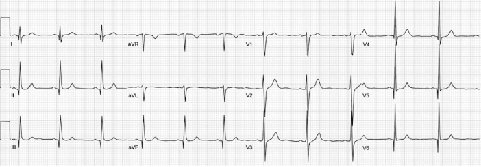 Rare Presentation of Newly Diagnosed HOCM EMRA