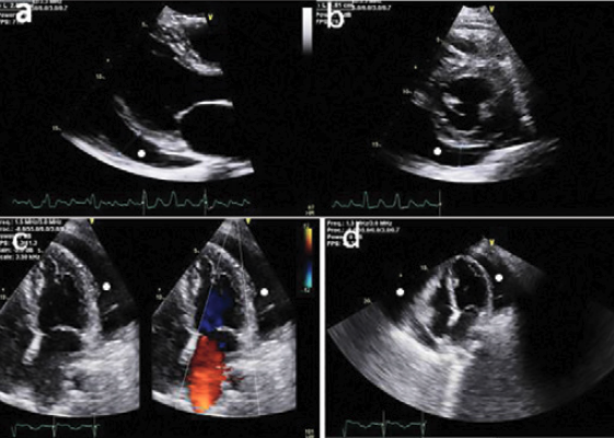 Pericardial Effusion: A Rare Case of a Potentially Dangerous ...