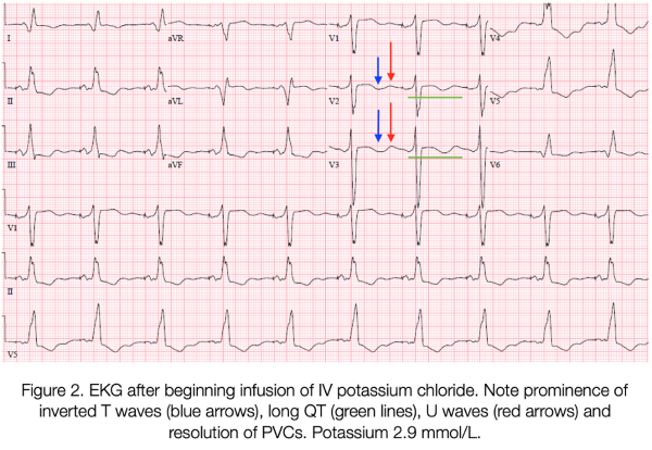 Shockingly Dangerous Hypokalemia EMRA