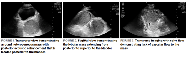 Intraabdominal Abscess Identified by Point-of-Care Ultrasound in a ...