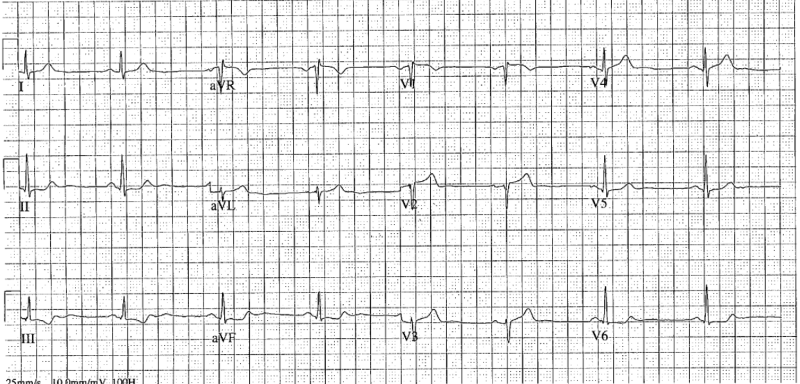 Sudden-Onset Chest Pain and Subtle ECG Findings EMRA