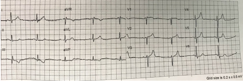 Sudden-Onset Chest Pain and Subtle ECG Findings EMRA