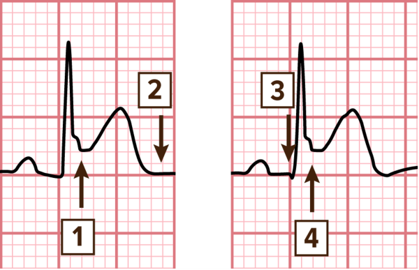 ECG Challenge: October-November 2021 EMRA