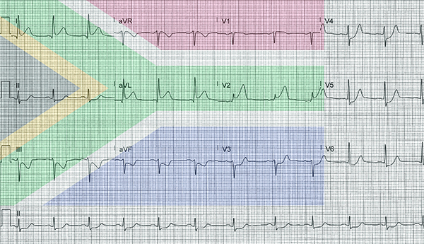 ECG Challenge: October-November 2021 EMRA