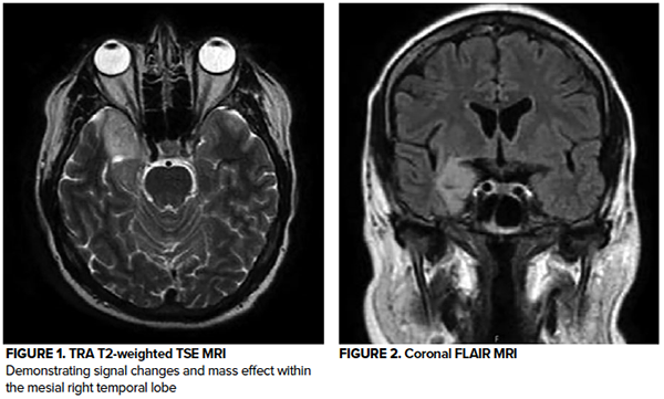 A Compelling Finding of Temporal Lobe Epilepsy EMRA