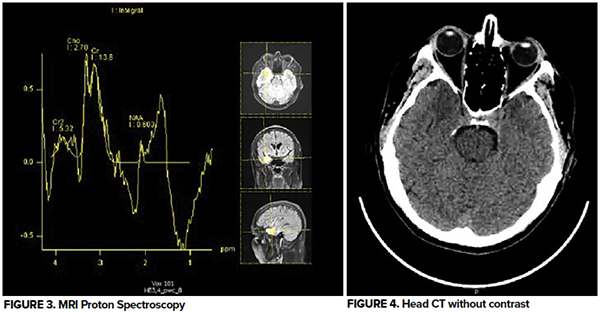 A Compelling Finding of Temporal Lobe Epilepsy EMRA