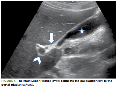 Where in The World is the CBD? Ultrasound Tips for Finding the Common ...