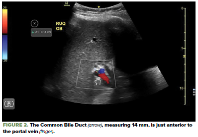 Where in The World is the CBD? Ultrasound Tips for Finding the Common ...