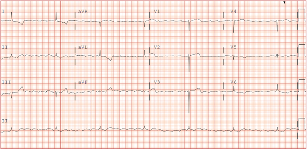 ECG Challenge: December-January 2021-2022 EMRA