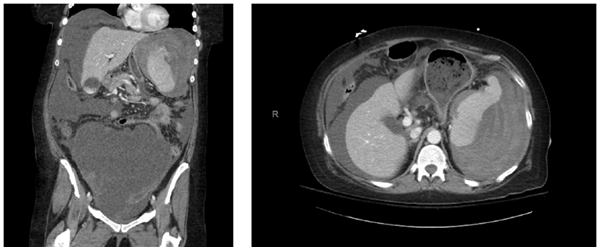 Atraumatic Splenic Rupture EMRA