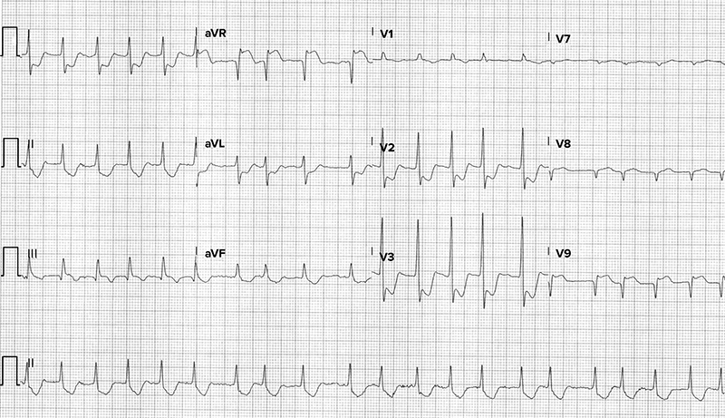 ECG Challenge: February-March 2022 EMRA