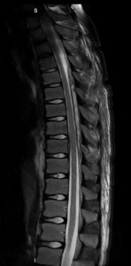 Recognizing and Managing Epidural Abscess EMRA