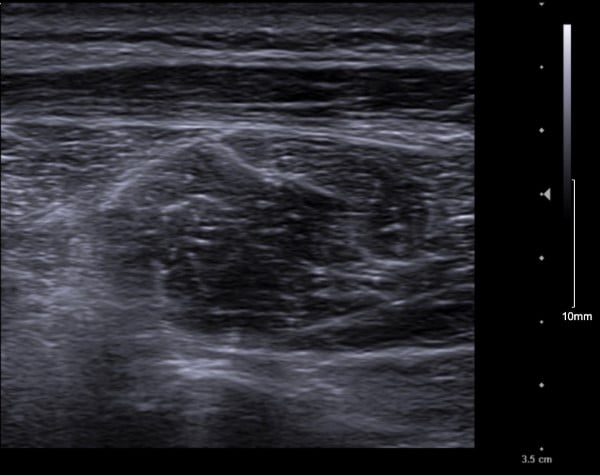 Recognizing and Managing Epidural Abscess EMRA