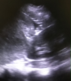 Contraceptives: Rare Complications and Their Implications for Emergency ...