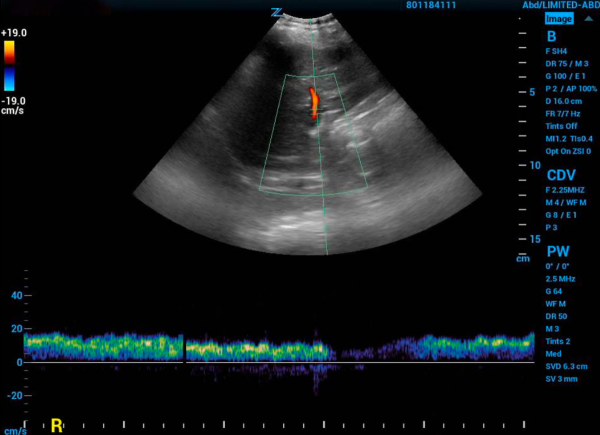Advanced Critical Care Ultrasound: VExUS--Can the Right Side Take It? EMRA
