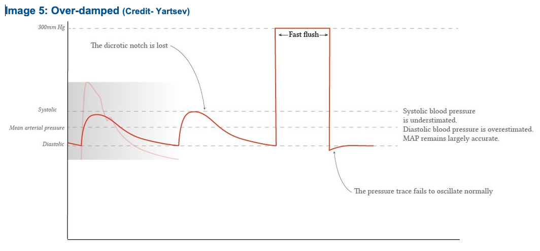 Critical Care Device Series: Arterial Lines Part 2 - Waveforms and ...