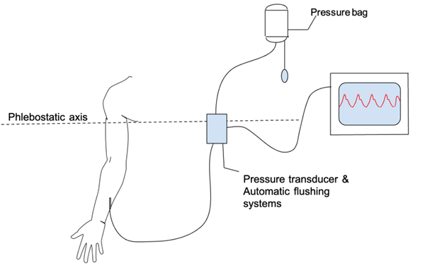 Critical Care Device Series: Arterial Lines Part 2 - Waveforms and ...